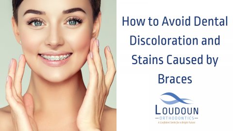 How to Avoid Dental Discoloration and Stains Caused by Braces