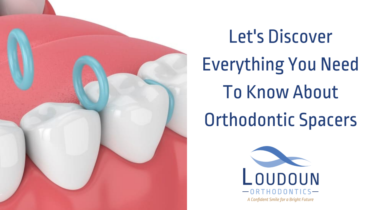 Everything You Need to Know About Orthodontic Spacers!