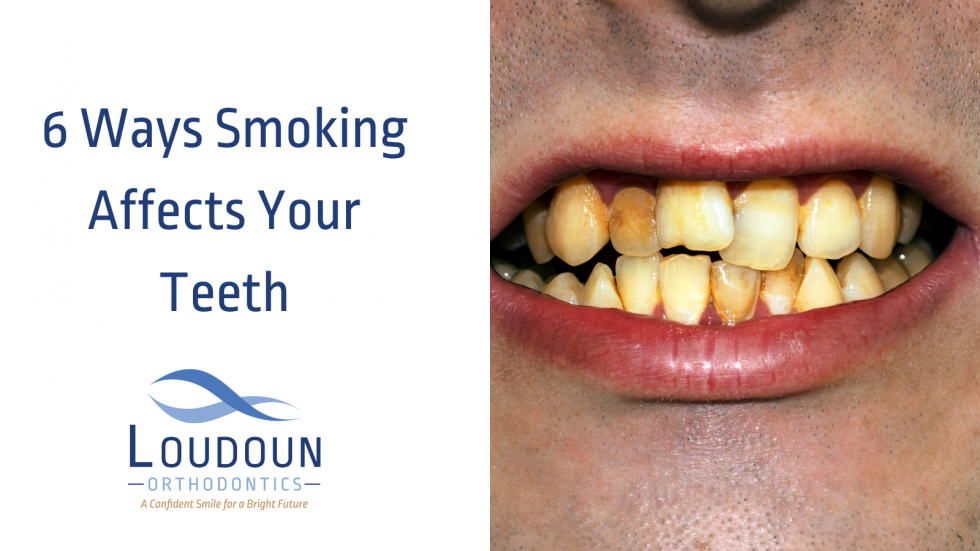 Six Ways Smoking Teeth Damage Happens