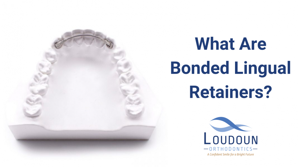 What Are Bonded Lingual Retainers?