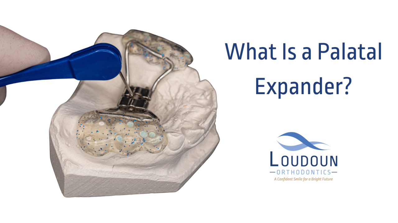What is a Palatal Expander?