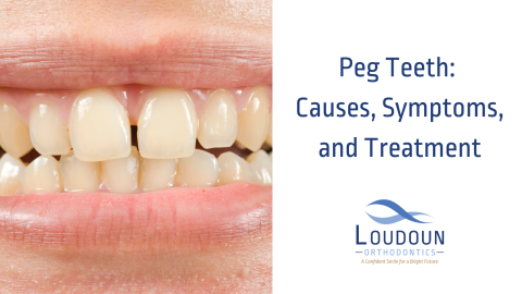 Peg Teeth: Causes, Symptoms, and Treatment