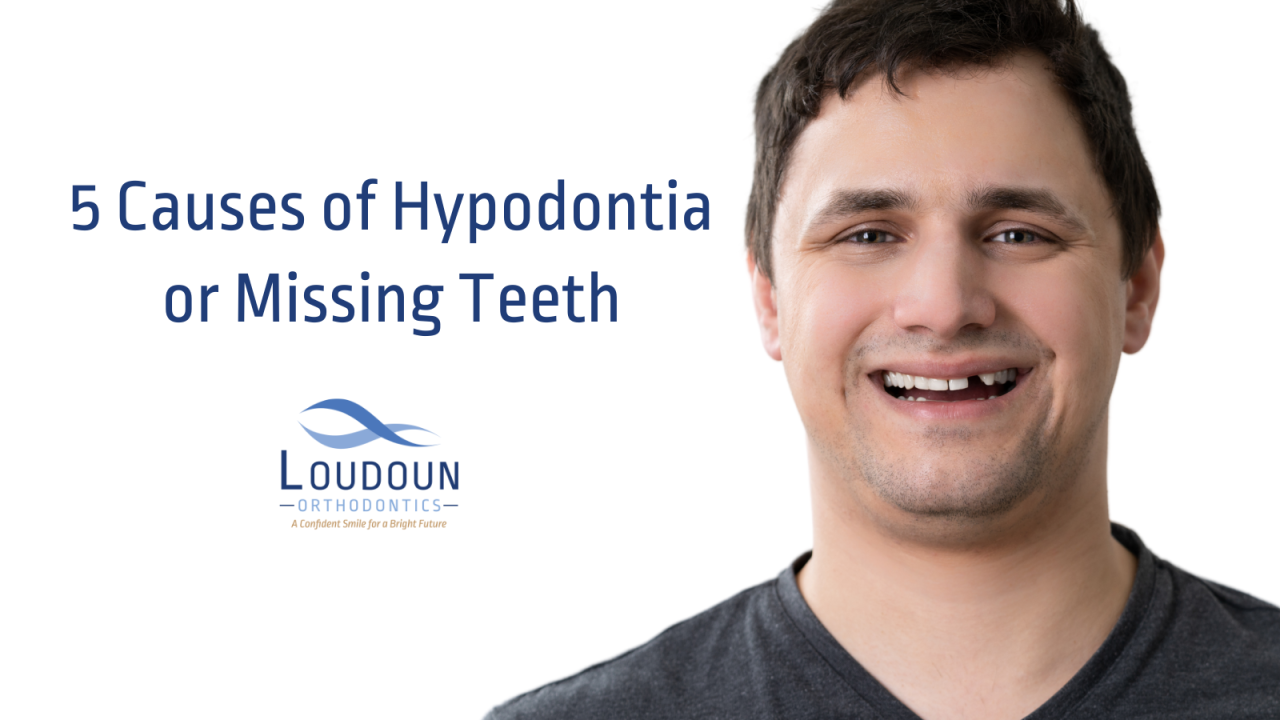 5 Causes of Hypodontia or Missing Teeth