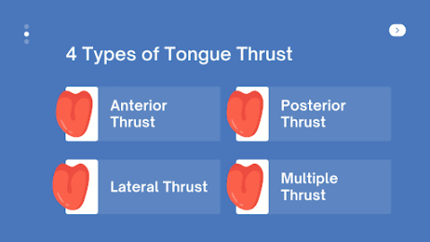 Everything You Need to Know About Tongue Thrusting