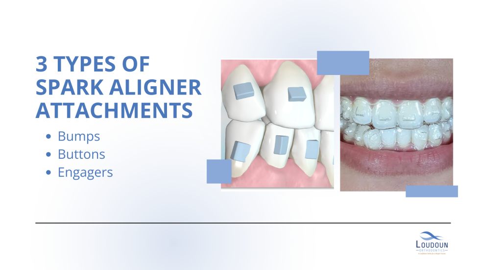 The Role of SPARK Aligner Attachments in Orthodontic Care