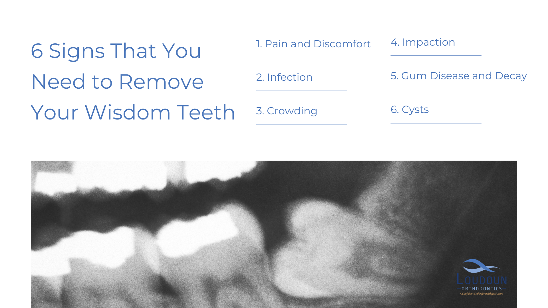 Can Wisdom Teeth Fall Out on Their Own?